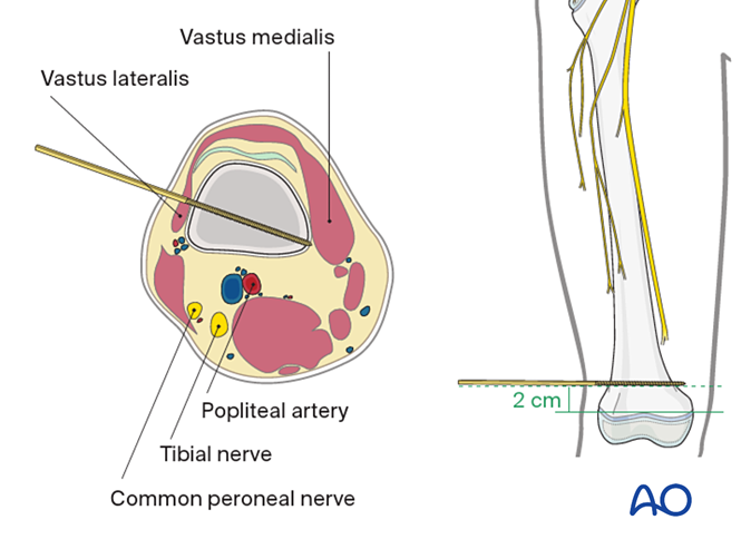 Safe zones for pin placement in the pediatric thigh and leg