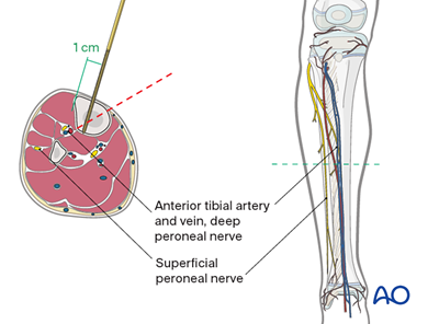 All approaches to the pediatric proximal tibia