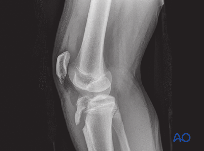 Highlights of Pediatric proximal tibia