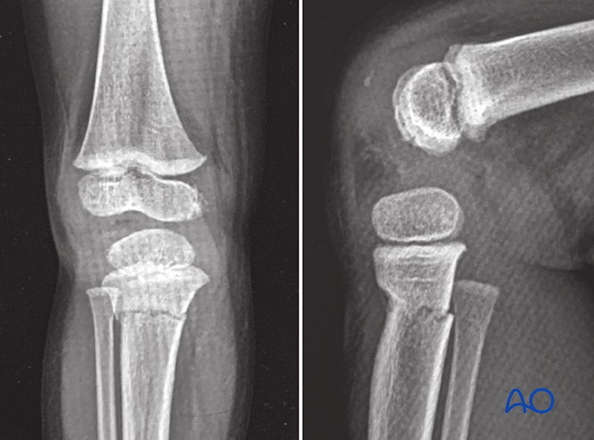 Complete metaphyseal and greenstick fracture