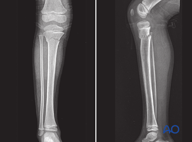 Complete metaphyseal and greenstick fracture
