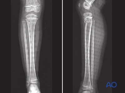 Complete metaphyseal and greenstick fracture