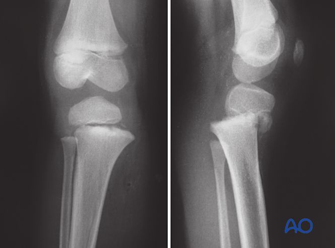 Epiphysiolysis (Salter-Harris I)
