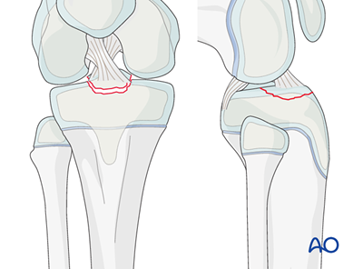 Avulsion of the tibial spine