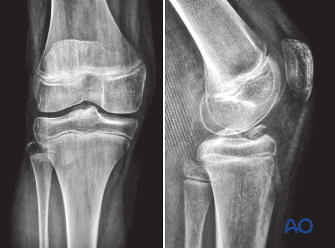 Avulsion of the tibial spine