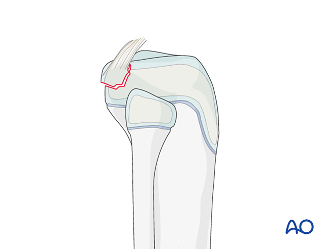 Avulsion fracture of the posterior crucial ligament