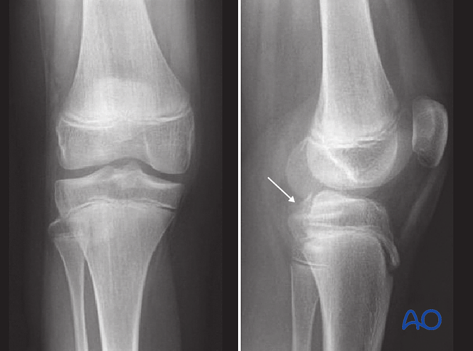 Avulsion fracture of the posterior crucial ligament