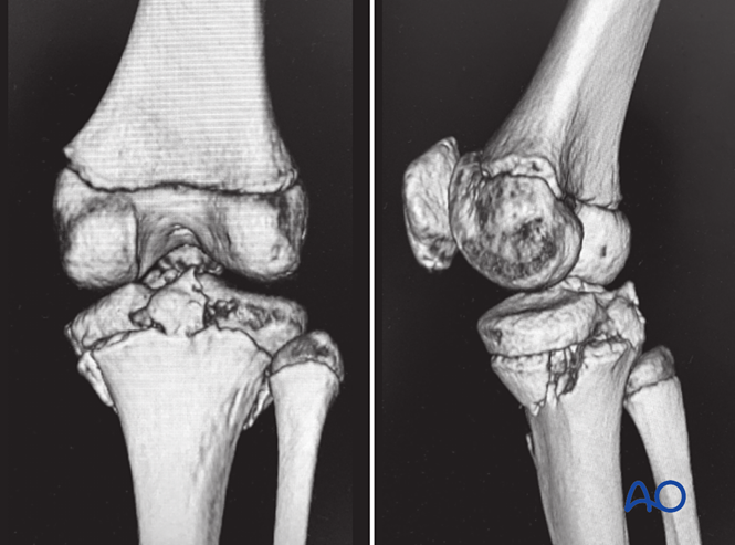 Avulsion fracture of the posterior crucial ligament