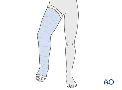Nonoperative treatment - Casting for Torus/buckle fracture