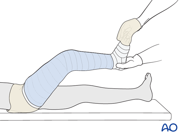 Long leg cast
