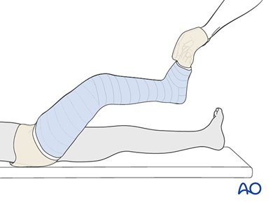 Long leg cast