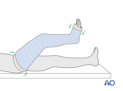 Nonoperative treatment - Casting for Torus/buckle fracture