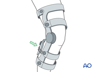Posterior cruciate ligament brace for Avulsion fracture of the ...
