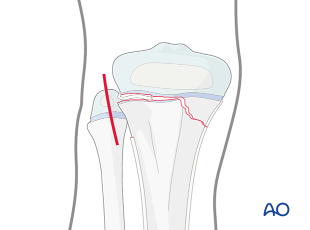 Open Reduction K Wire Fixation For Epiphysiolysis With Metaphyseal