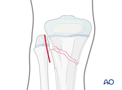 Closed reduction - K-wire fixation for Complete metaphyseal and ...