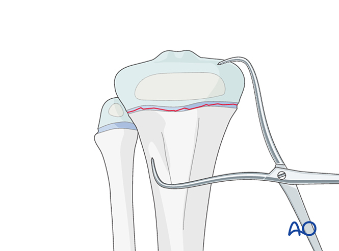 Open reduction - K-wire fixation for Epiphysiolysis (Salter-Harris I)