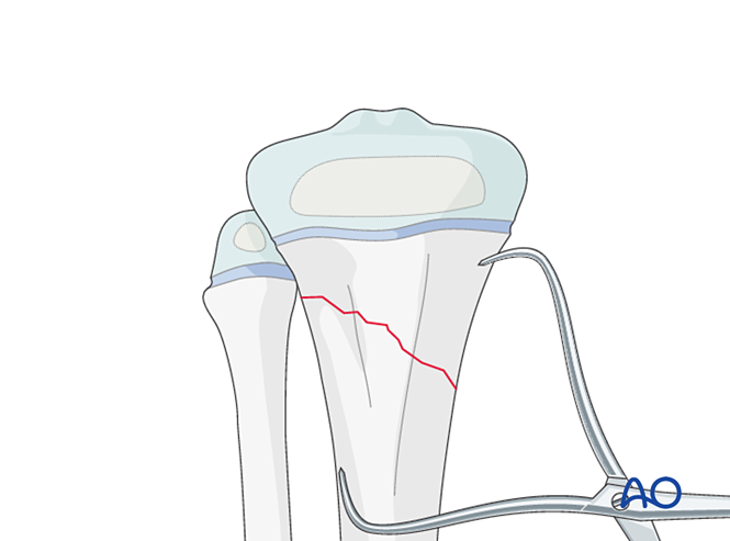 Open reduction - K-wire fixation for Complete metaphyseal and ...