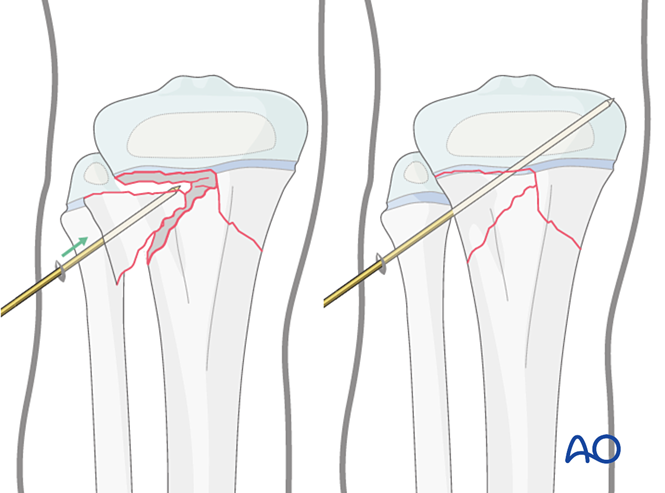 Closed reduction - K-wire fixation for Epiphysiolysis with metaphyseal ...