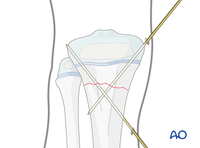 Closed reduction - K-wire fixation for Complete metaphyseal and ...
