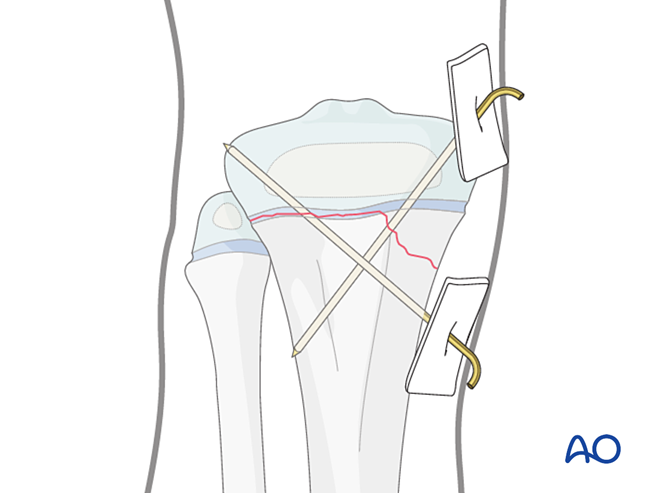 Closed Reduction K Wire Fixation For Epiphysiolysis With Metaphyseal