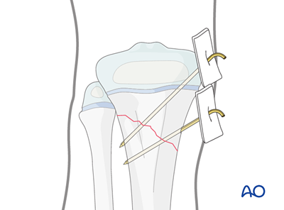 Closed reduction - K-wire fixation for Complete metaphyseal and ...