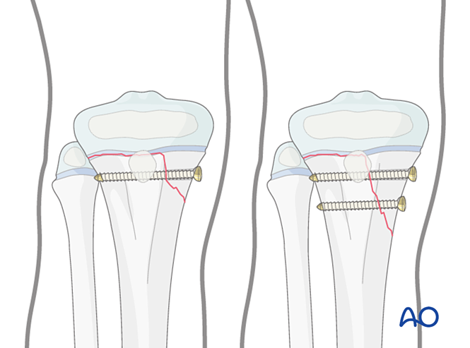 Closed reduction - Screw fixation for Epiphysiolysis with metaphyseal ...