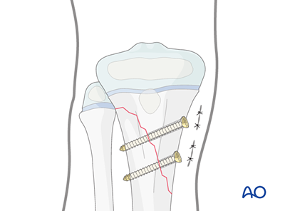 Closed reduction - Screw fixation for Complete metaphyseal and ...