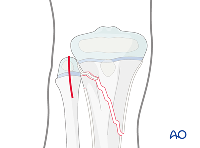 Open reduction - Screw fixation for Complete metaphyseal and greenstick ...
