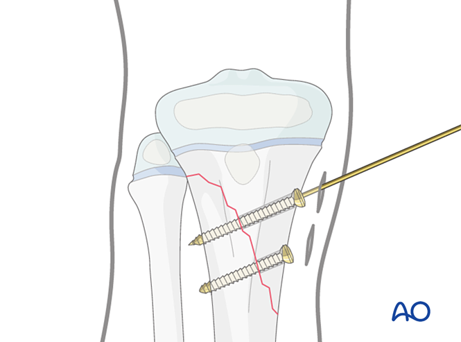 Closed reduction - Screw fixation for Complete metaphyseal and ...