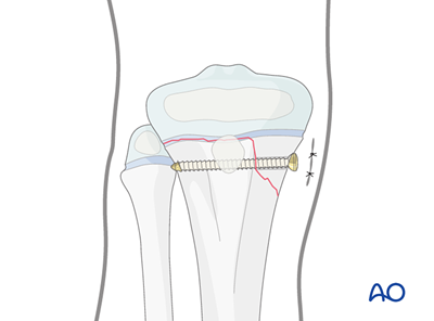 Closed reduction - Screw fixation for Epiphysiolysis with metaphyseal ...