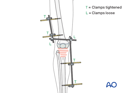 External fixation for temporary stabilization for Complete metaphyseal ...