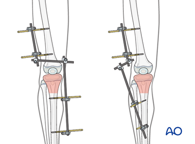 External fixation for temporary stabilization for Epiphysiolysis ...