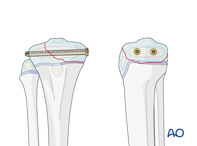 Open reduction - Screw fixation for Epiphyseal and epi-metaphyseal ...