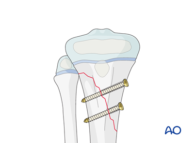 Open reduction - Screw fixation for Complete metaphyseal and greenstick ...