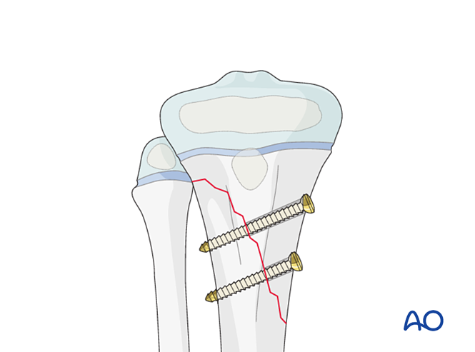 Open reduction - Screw fixation for Complete metaphyseal and greenstick ...