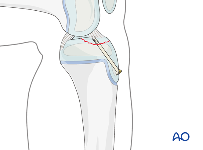 Arthroscopically assisted screw fixation for Avulsion of the tibial spine