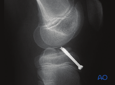Arthroscopically assisted screw fixation for Avulsion of the tibial spine