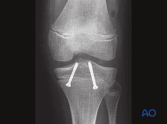 Arthroscopically assisted screw fixation for Avulsion of the tibial spine