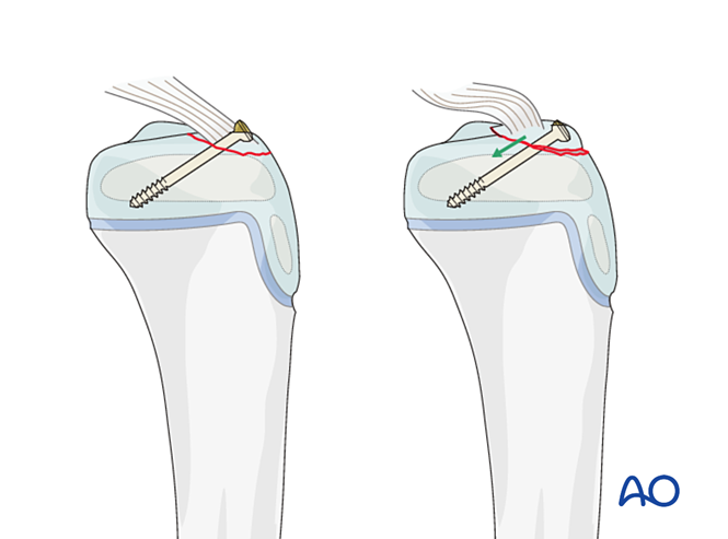 Open reduction - Screw fixation for Avulsion of the tibial spine