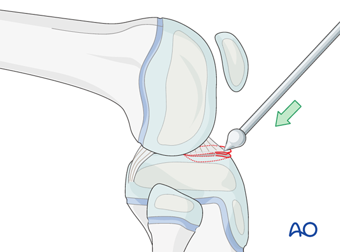 Open reduction - Screw fixation for Avulsion of the tibial spine