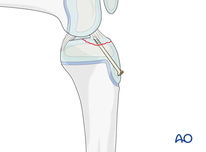 Open reduction - Screw fixation for Avulsion of the tibial spine