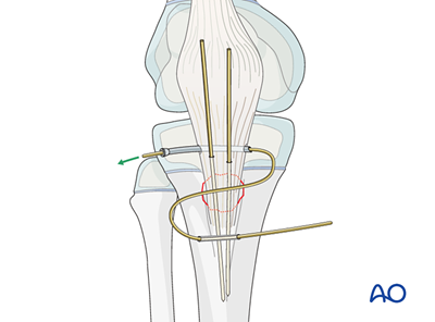 Cerclage compression wiring for Avulsion of the apophysis