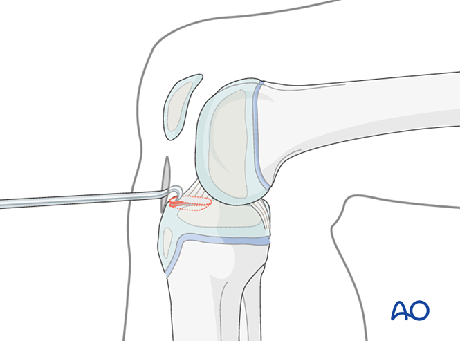 Suture fixation for Avulsion of the tibial spine