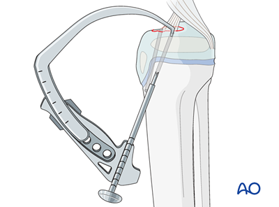 Suture fixation for Avulsion of the tibial spine