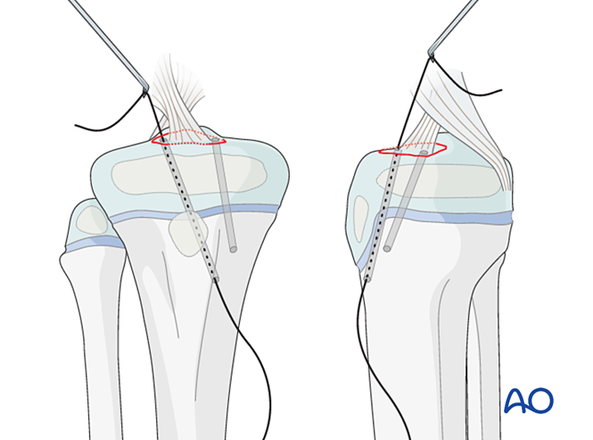Suture fixation for Avulsion of the tibial spine