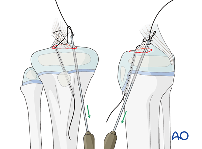 Suture fixation for Avulsion of the tibial spine