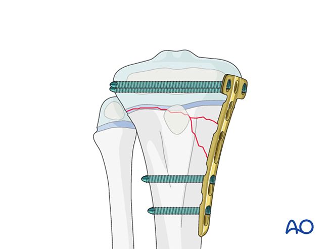 Open reduction - Plate fixation for Epiphysiolysis with metaphyseal ...