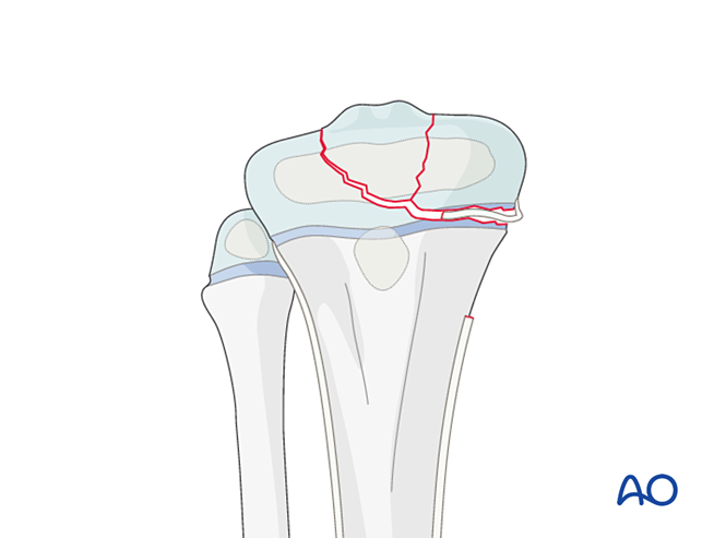 Open reduction - Plate fixation for Epiphyseal and epi-metaphyseal ...