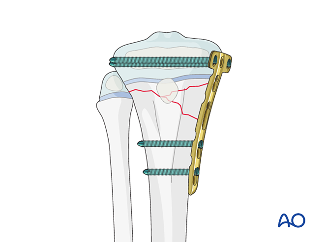 Open reduction - Plate fixation for Complete metaphyseal and greenstick ...