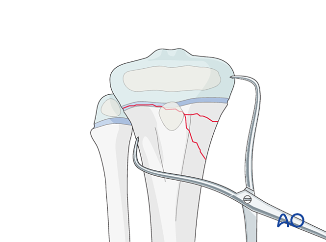 Open reduction - Plate fixation for Epiphysiolysis with metaphyseal ...
